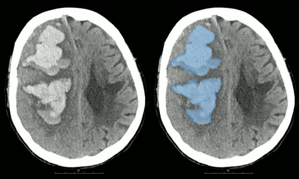 Anticoagulation and cerebral small vessel disease – what really causes ...